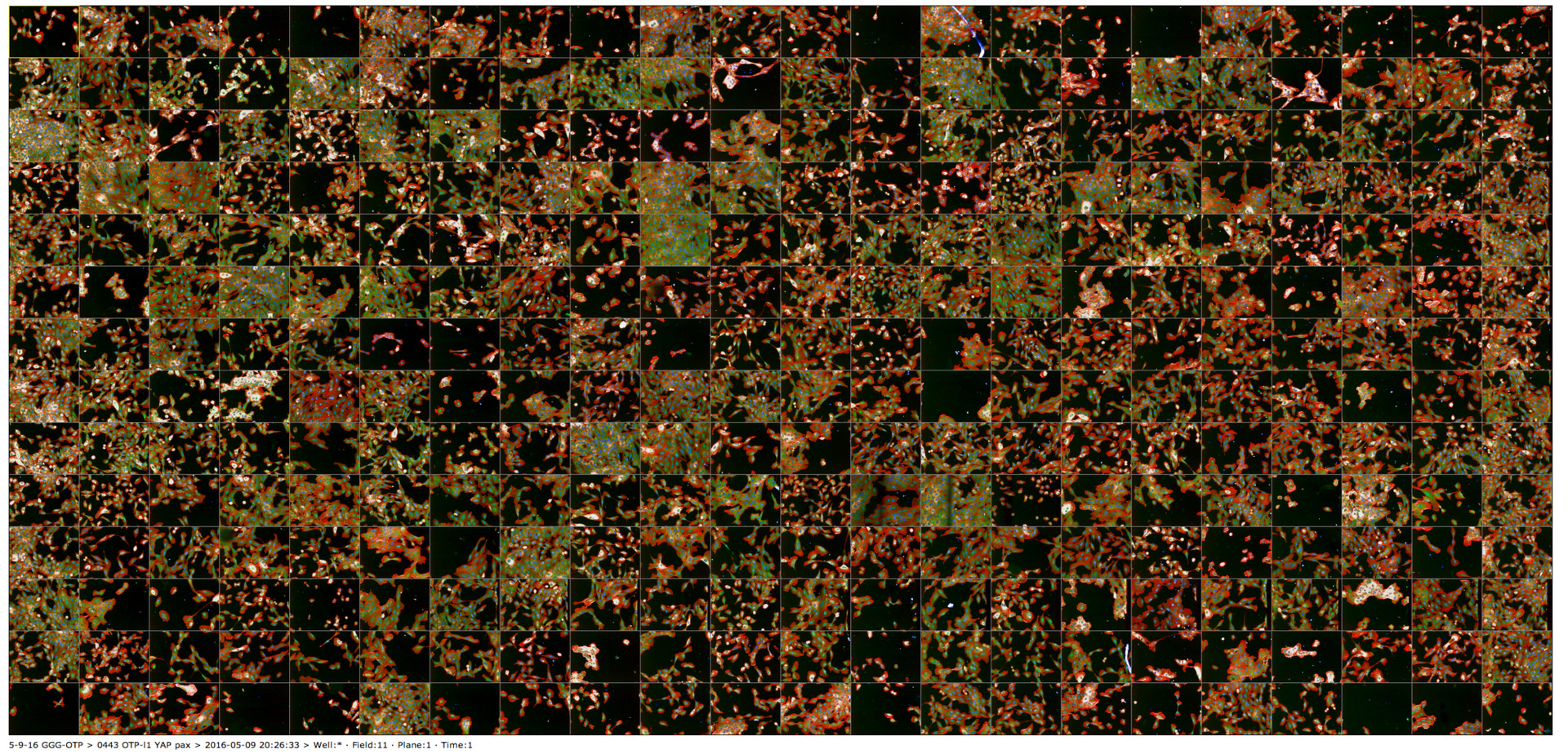 UK researchers find metastasis switch in breast cancer cells - European ...