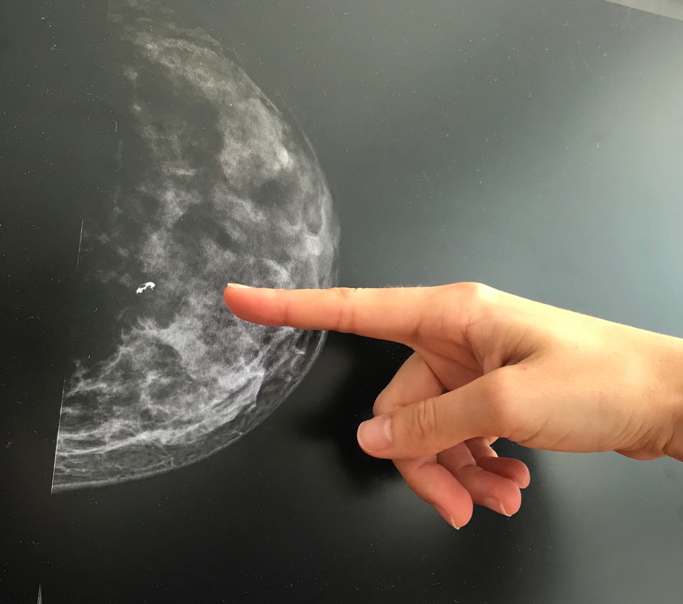 Smart bra set to detect breast cancer - European Biotechnology Magazine