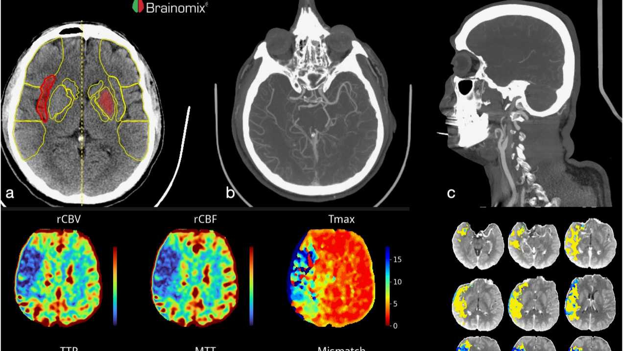 Brainomix Ltd. completes £14m Series C financing - European ...